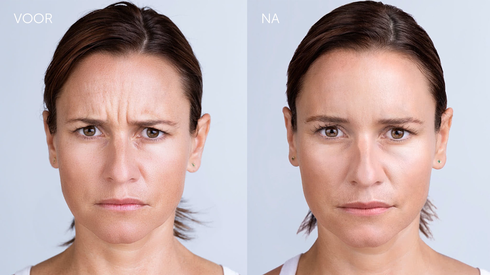 Botox behandeling in Amsterdam - Easy Cosmetics